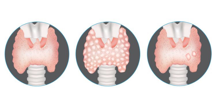 Hipotiroidism versus hipertiroidism. Cum le deosebim