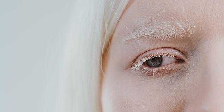 Despre albinism, clasificare, cauze genetice, diagnostic