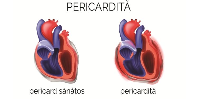 Pericardita - ce este, care sunt simptomele si optiunile de tratament