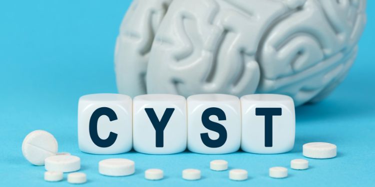 Chist arahnoidian – informatii despre cauze, manifestari si tratament