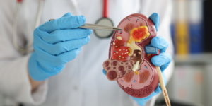 Informatii despre feritina – valori de referinta, cauze valori anormale