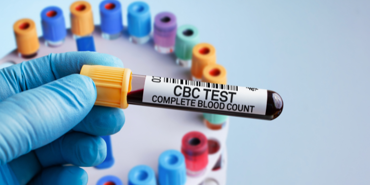 PDW crescut – interpretare si implicatii clinice