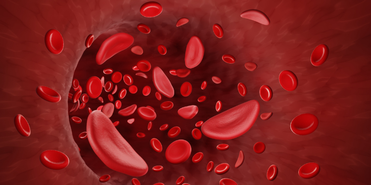 Anemie falciforma: ce inseamna, simptome, tratament